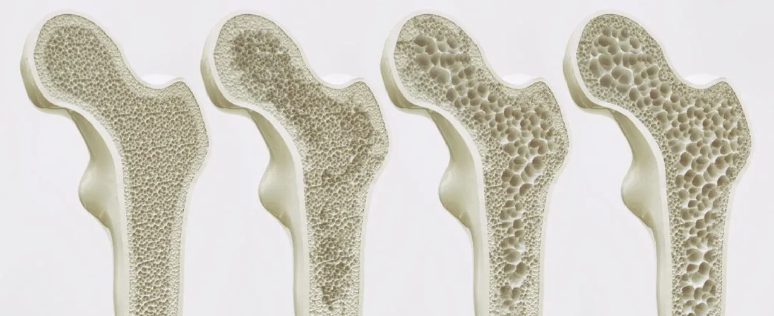 Bone Density Scan: What It Is, Who Needs One, and Why It’s Important ...